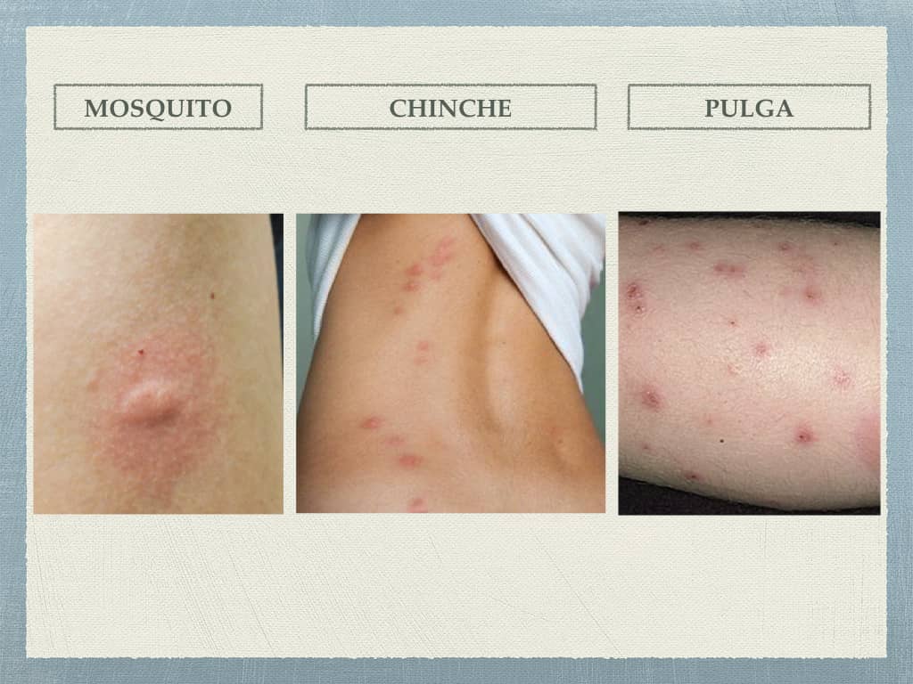 Especial verano: Me ha picado un bicho - Dra Garín Pediatra