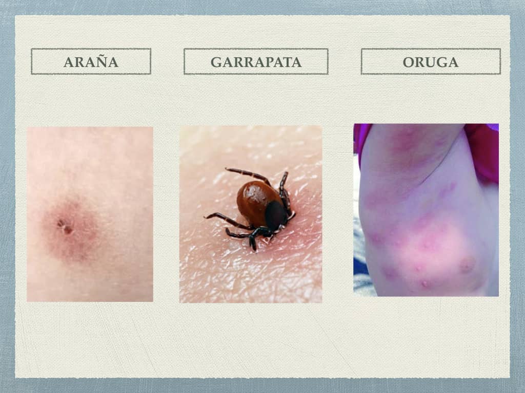 Especial verano: Me ha picado un bicho - Dra Garín Pediatra