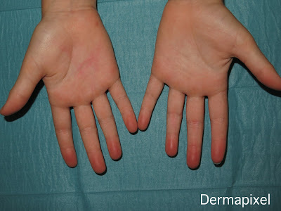 Patología de verano: pulpitis - Dra Garín Pediatra