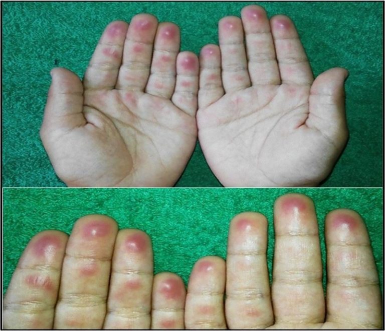 Patología de verano: pulpitis - Dra Garín Pediatra