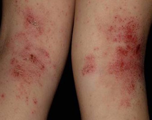 Atopia, causas y manifestaciones - Dra Garín Pediatra